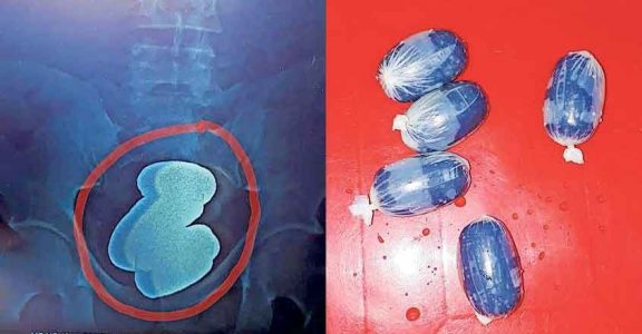 Here is how gold is smuggled by hiding it inside the human body ...