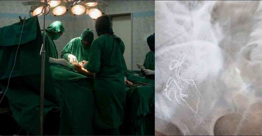 Surgical material left behind in woman’s womb at Kollam hospital